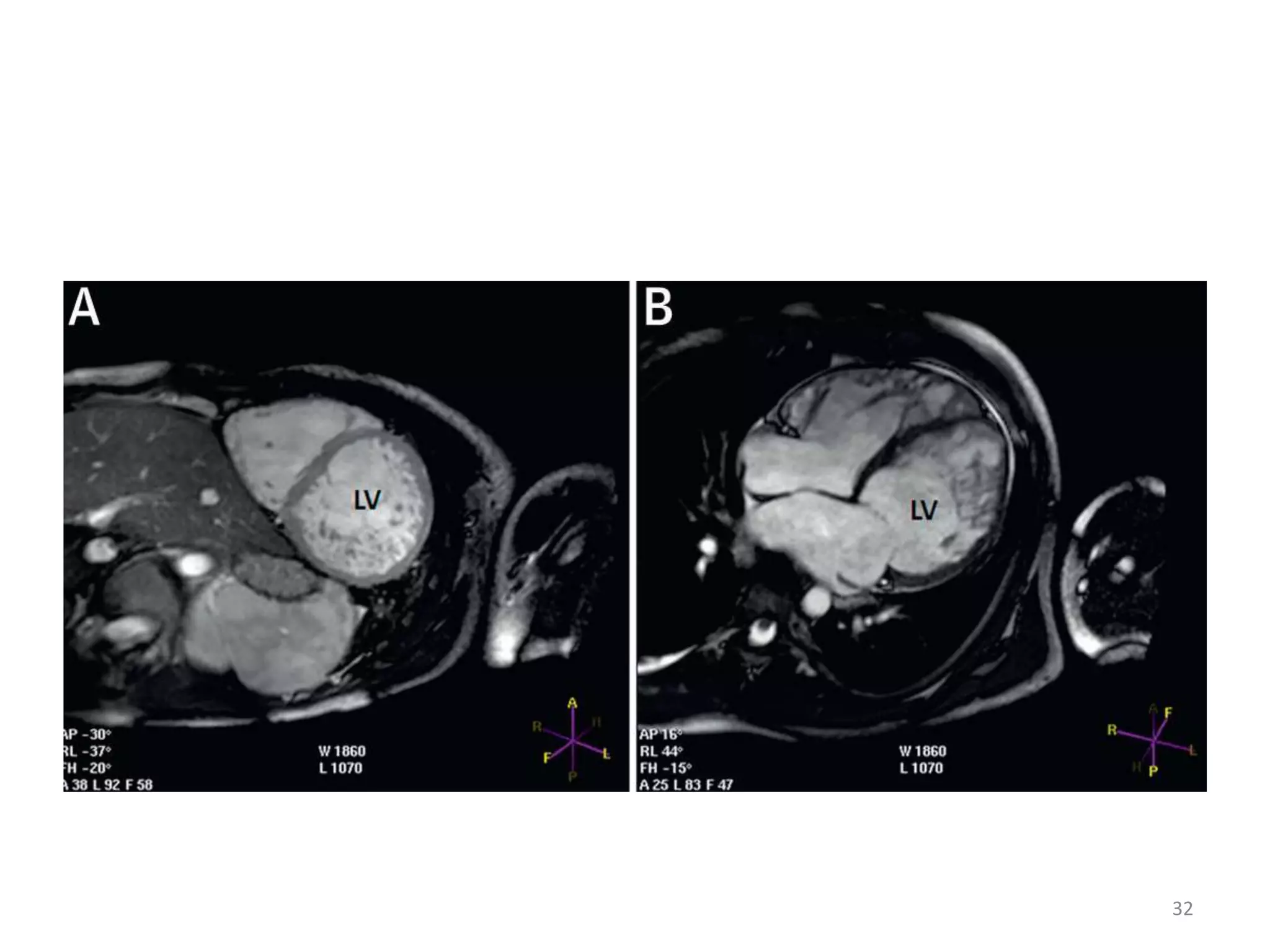 Left ventricular non compaction | PPTX