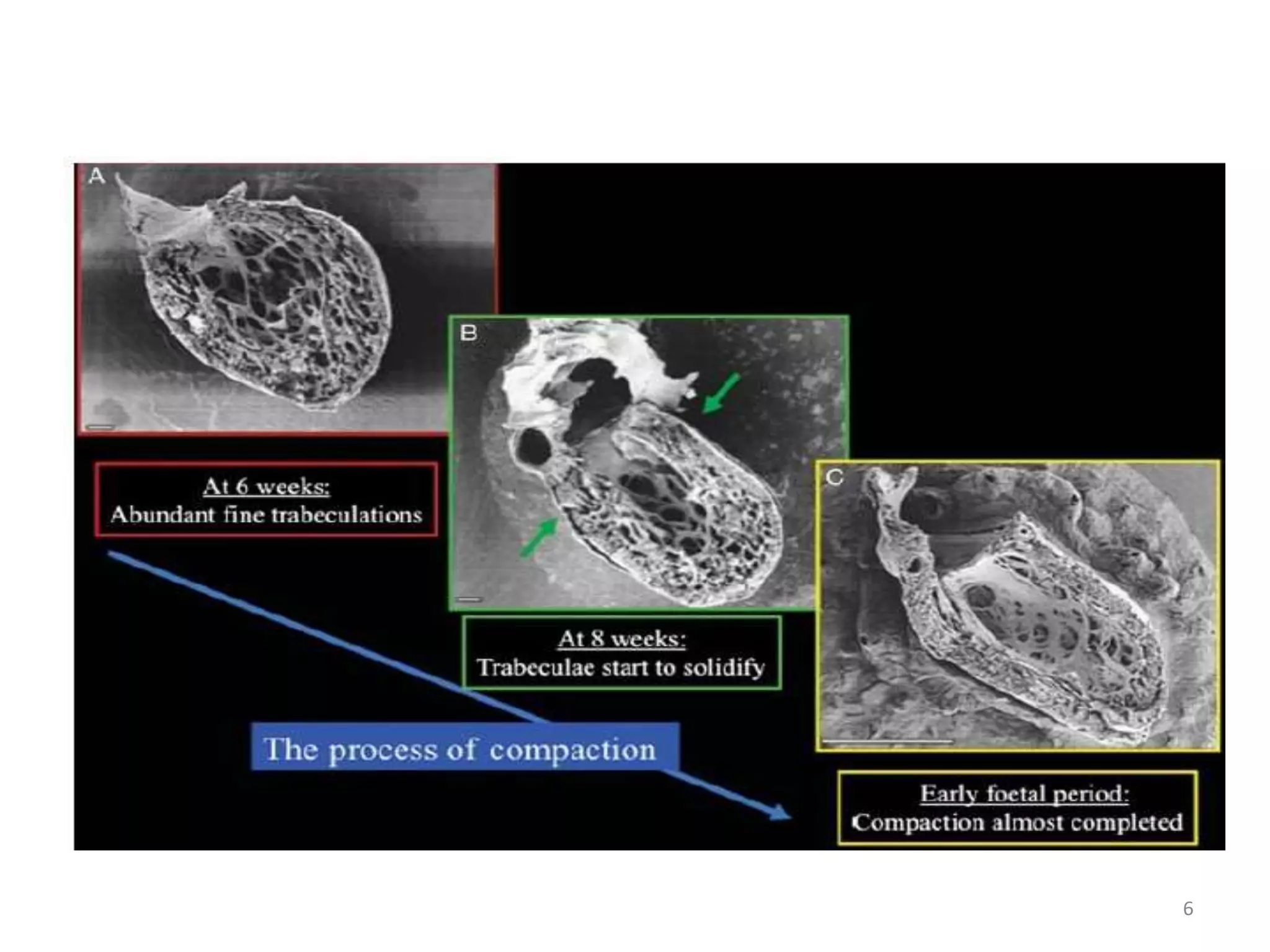 Left ventricular non compaction | PPTX