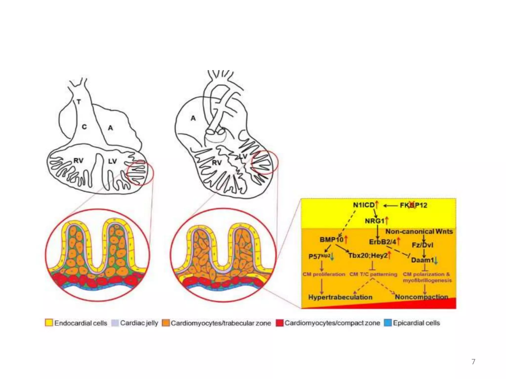 Left ventricular non compaction | PPTX