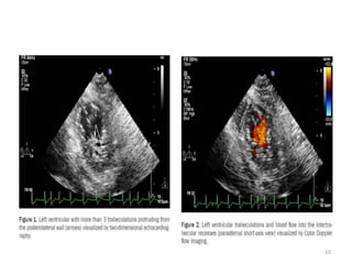 Left ventricular non compaction | PPTX