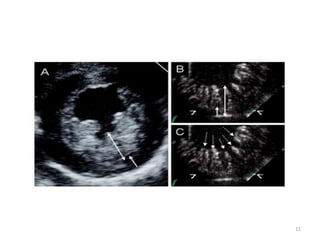 Left ventricular non compaction | PPTX