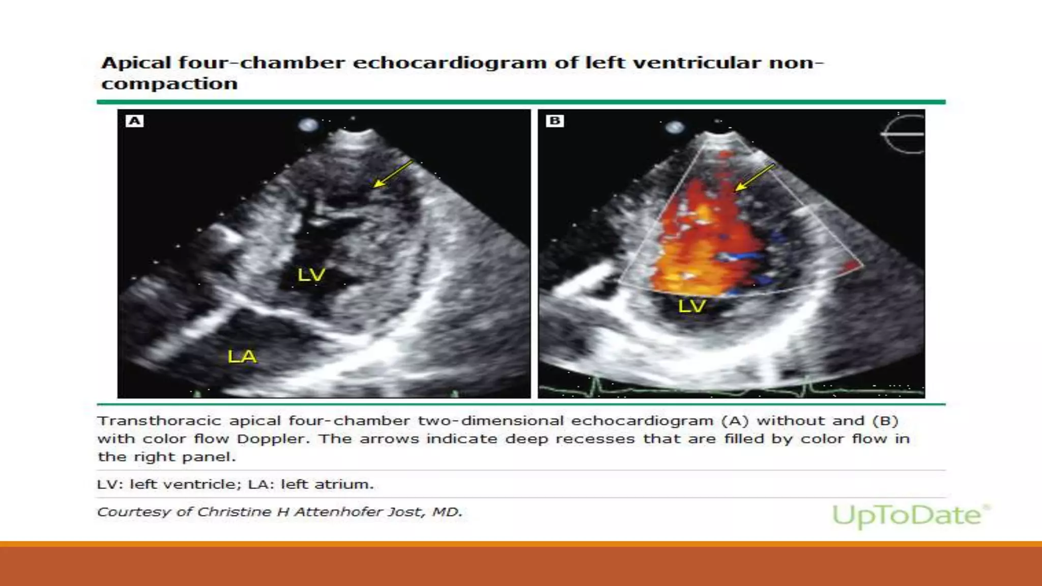 Left ventricular noncompaction | PPT