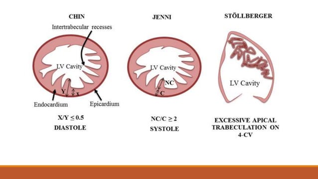 Left ventricular noncompaction | PPT