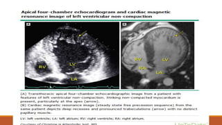 Left ventricular noncompaction | PPTX