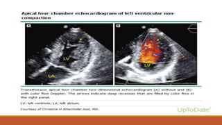 Left ventricular noncompaction | PPTX