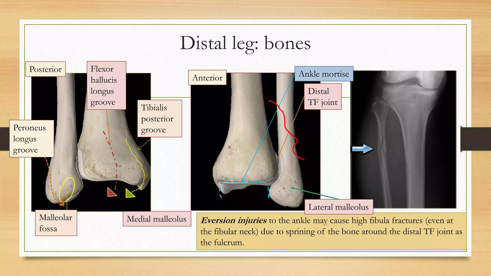 Leg: from anatomy to orthopedisc | PPTX