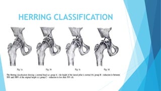 Legg calve-perthes disease | PPT
