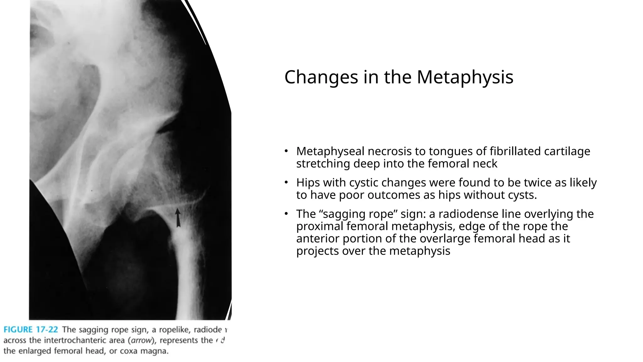 Legg-Calvé-Perthes Disease of hip .pptx