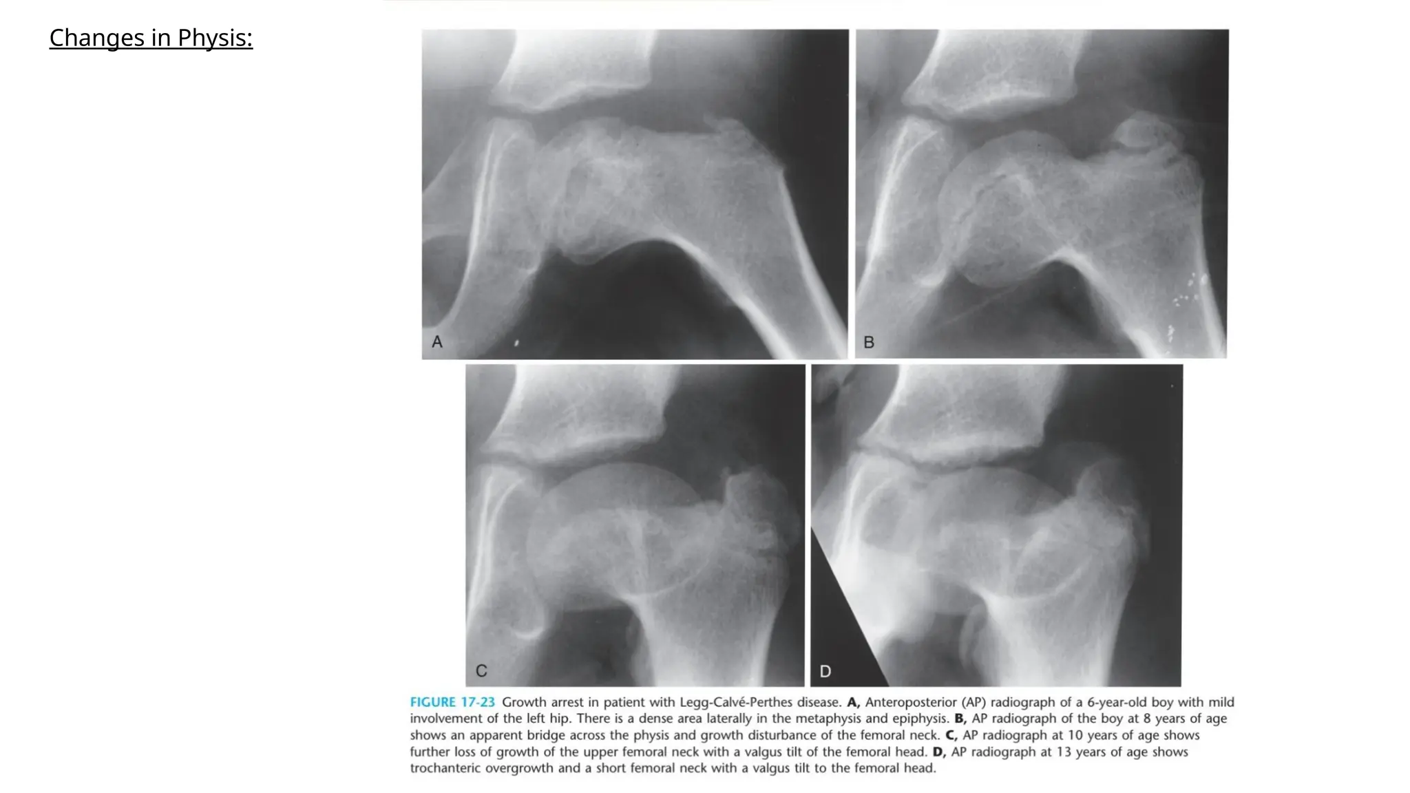 Legg-Calvé-Perthes Disease of hip .pptx