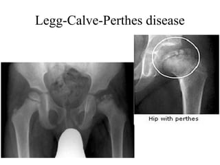 Legg-Calve-Perthes disease of the lower limb.pptx