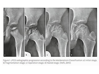 Legg-Calve-Perthes disease of the lower limb.pptx