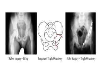 Legg-Calve-Perthes disease of the lower limb.pptx