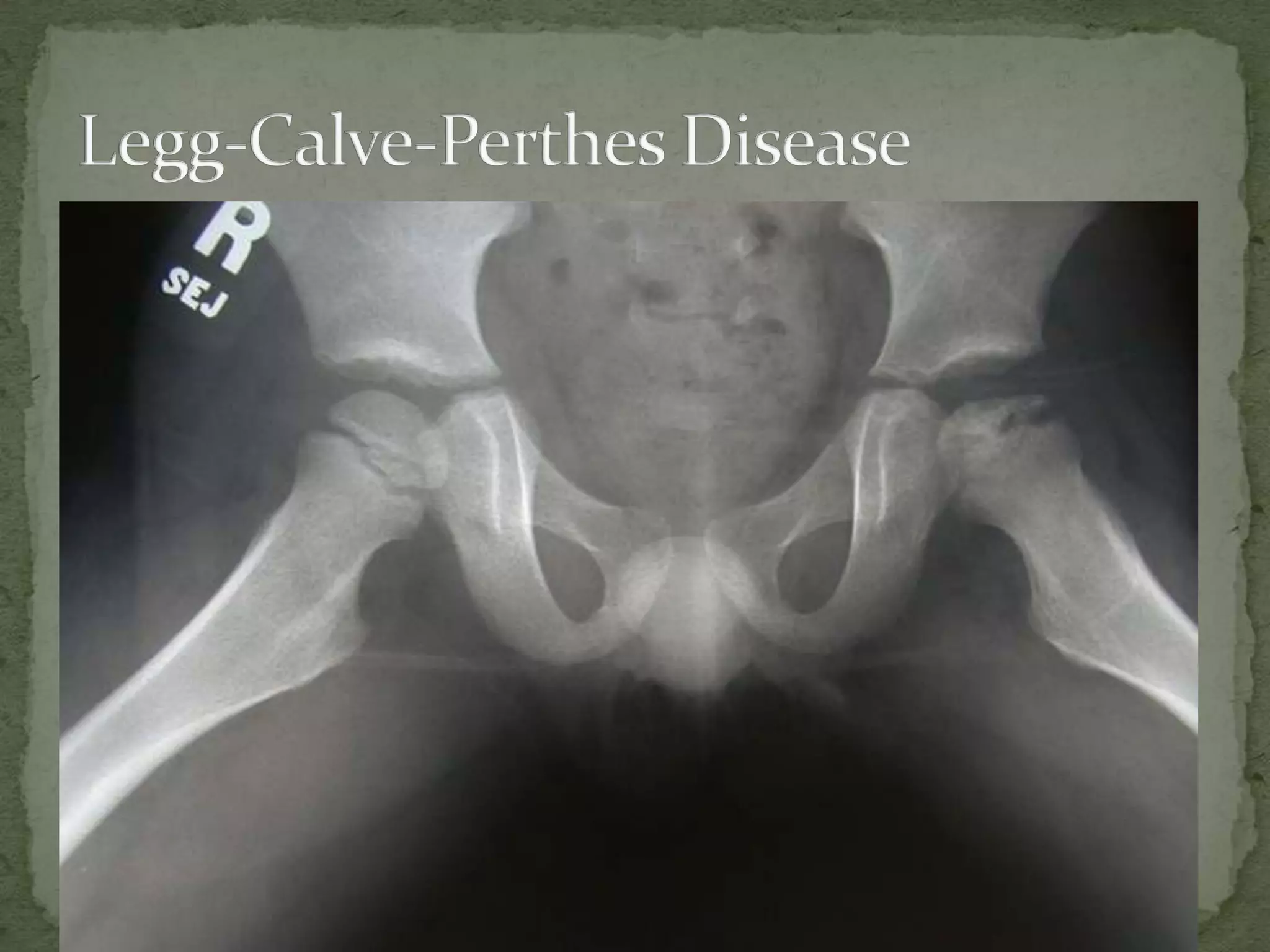 Legg calve perthes Power Point | PPT