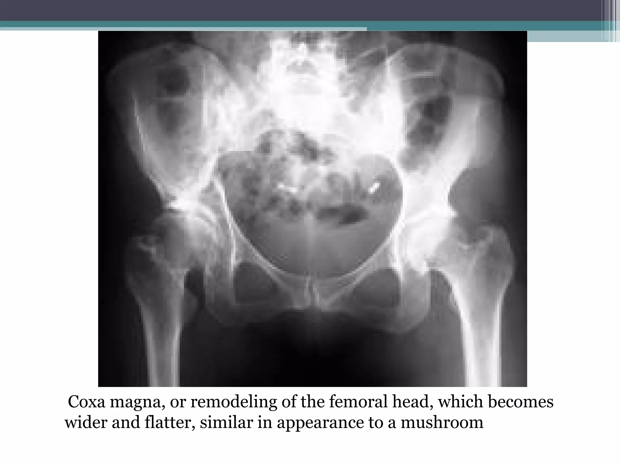 Legg calve perthes | PPT