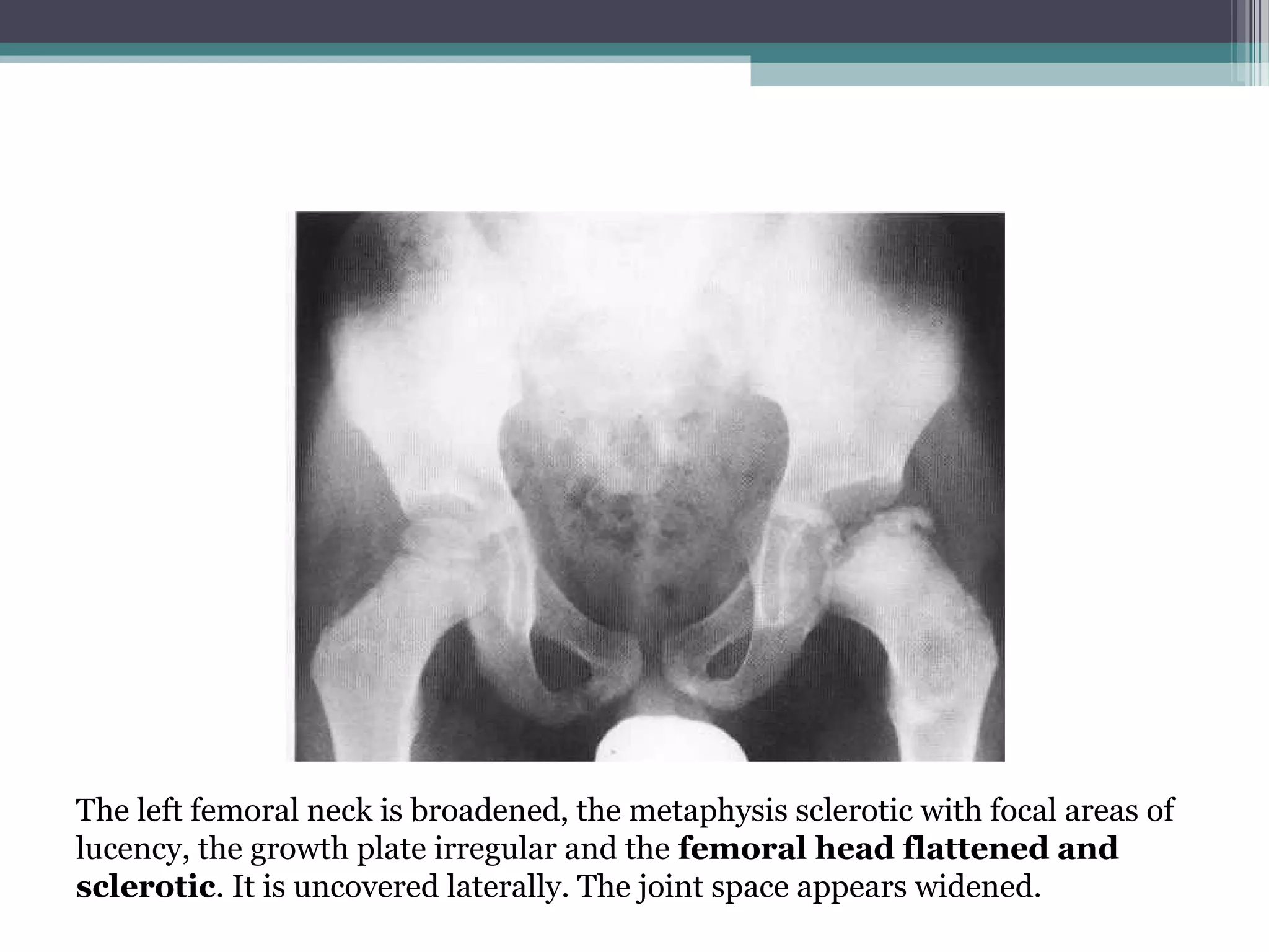 Legg calve perthes | PPT
