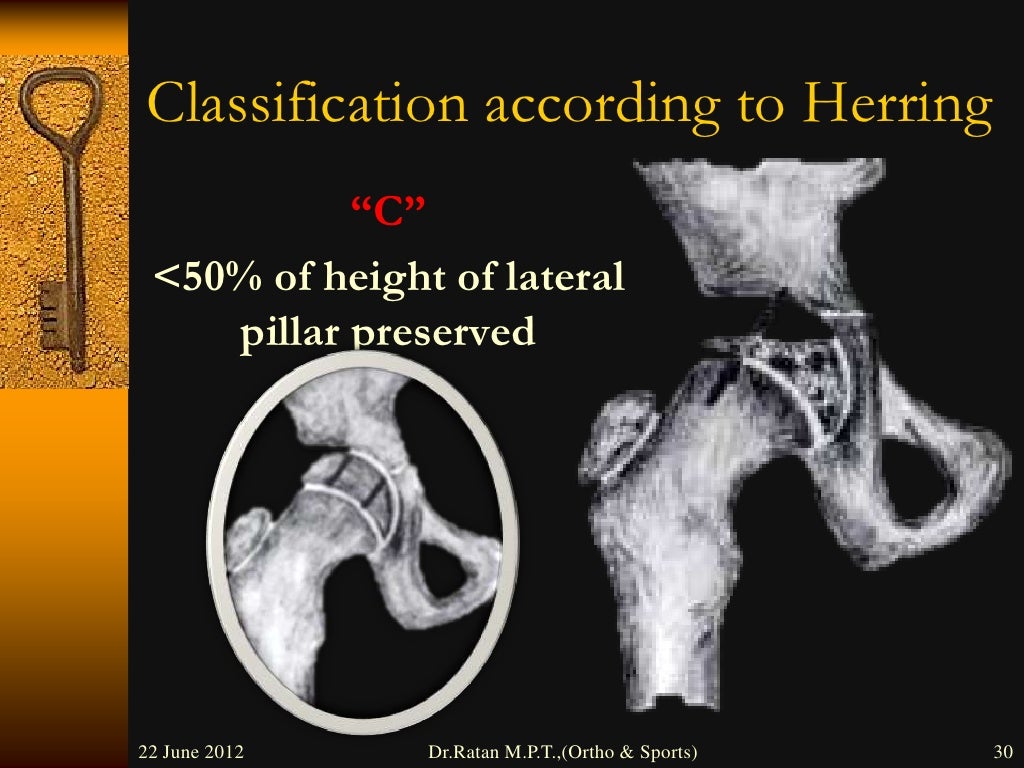 Legg calve perthes disease