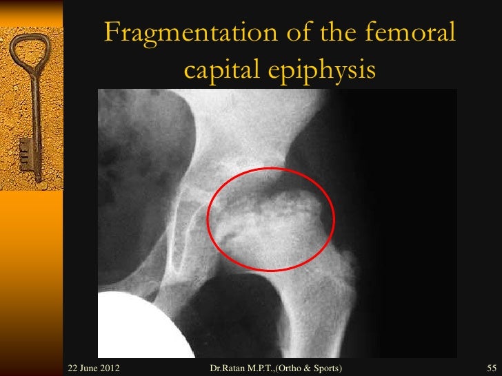 Legg calve perthes disease