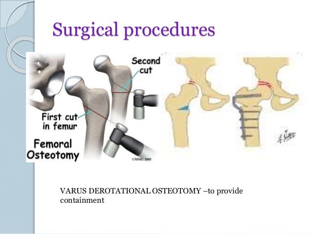 Legg calve perthes disease