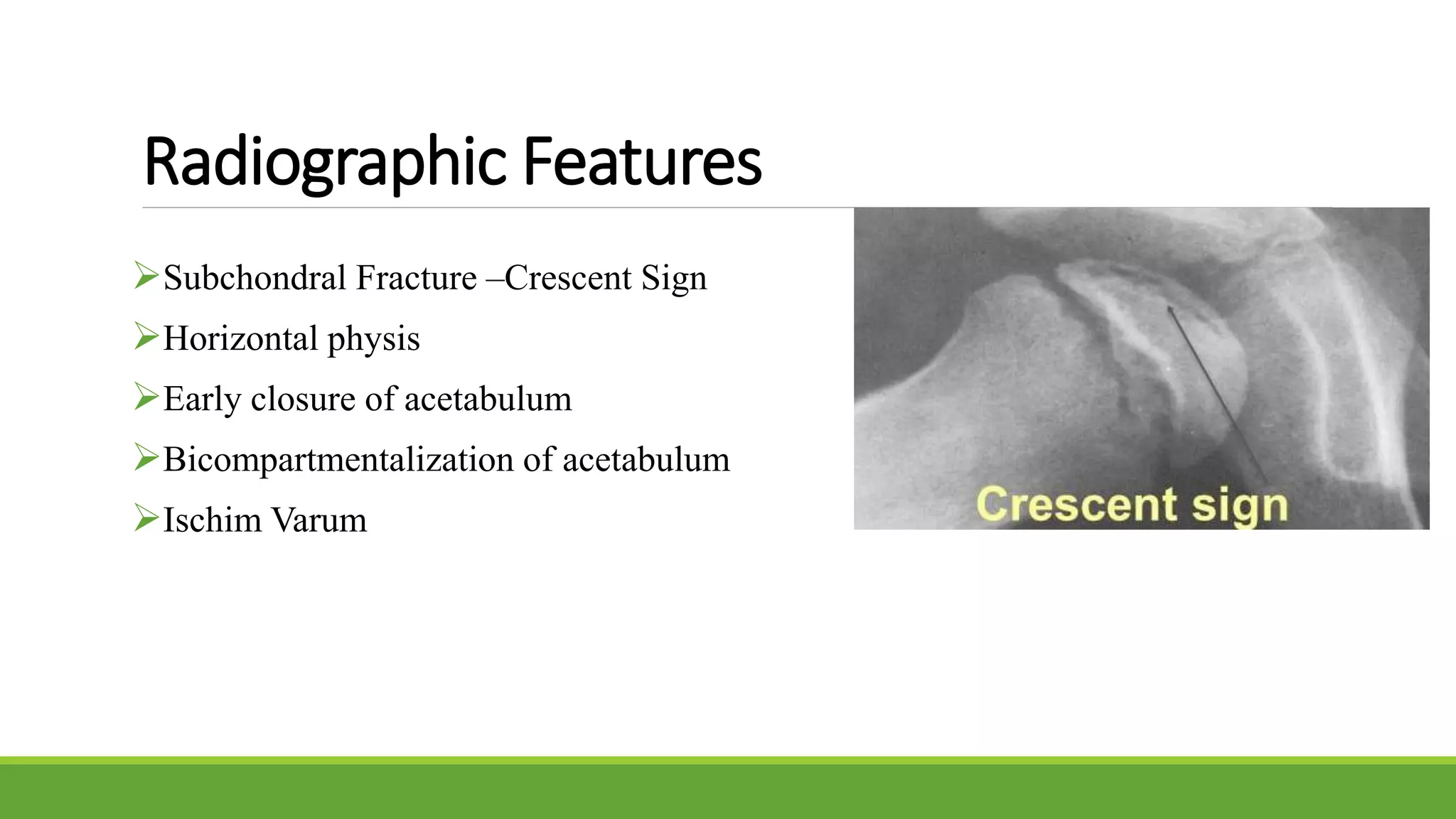 Legg calve perthes disease | PPTX