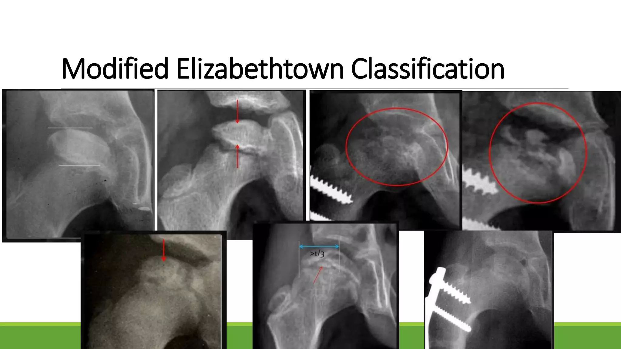 Legg calve perthes disease | PPTX