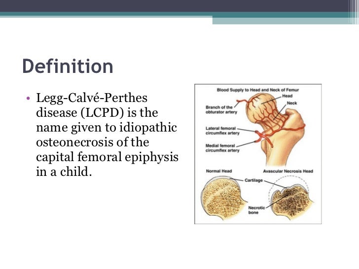 Legg Calve Perthes Disease Legg Calve Perthes Disease
