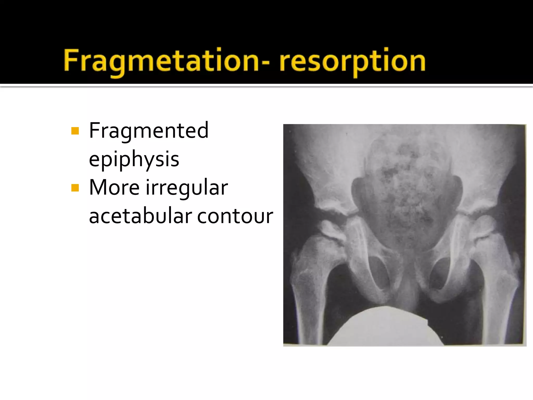 Legg's calve perthes disease | PPT