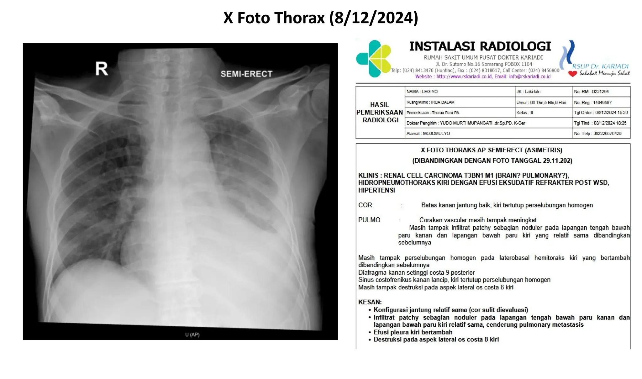 Legiyo - Renal Cell Carcinoma T3bN1 M1, Hipotensi, Hiponatremia (124 ...