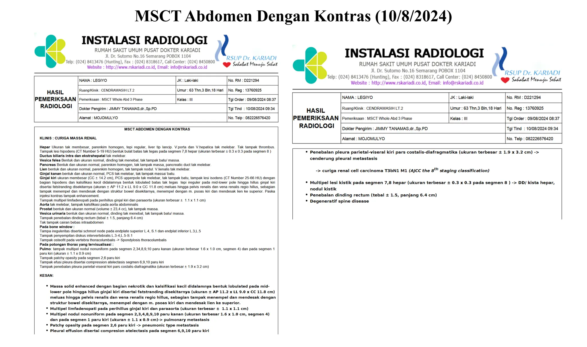 Legiyo - Renal Cell Carcinoma T3bN1 M1, Hipotensi, Hiponatremia (124 ...