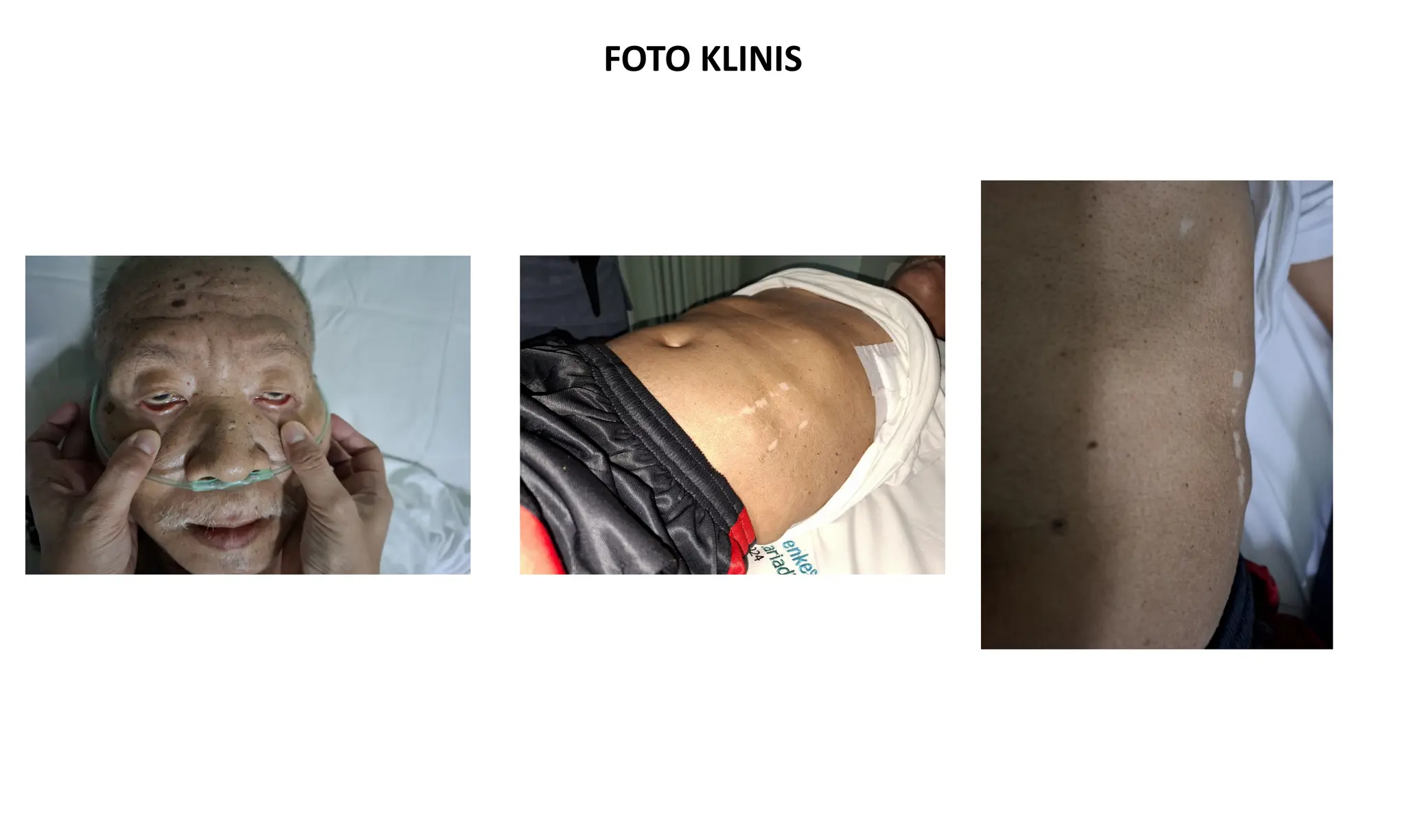 Legiyo - Renal Cell Carcinoma T3bN1 M1, Hipotensi, Hiponatremia (124 ...