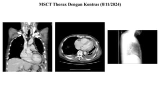 Legiyo - Renal Cell Carcinoma T3bN1 M1, Hipotensi, Hiponatremia (124 ...