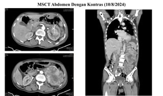 Legiyo - Renal Cell Carcinoma T3bN1 M1, Hipotensi, Hiponatremia (124 ...
