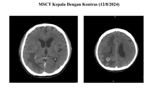 Legiyo - Renal Cell Carcinoma T3bN1 M1, Hipotensi, Hiponatremia (124 ...
