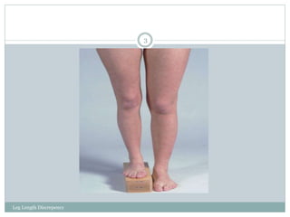 Leg Length Discrepancy.pdf