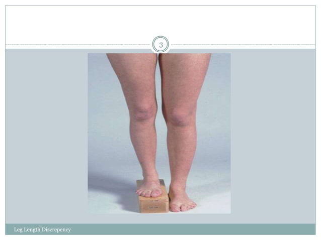 Leg Length Discrepancy.pdf
