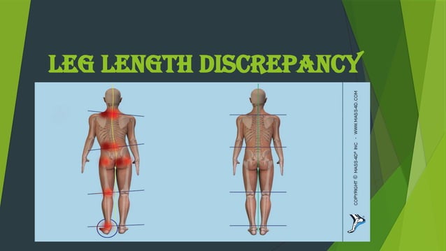 LEG LENGTH DISCREPANCY asessment and management.pptx