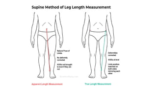 Leg Length Measurement true and apparent measurement limb length ...