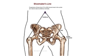 Leg Length Measurement true and apparent measurement limb length ...