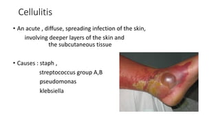 seminar on Leg swelling & its causes | PDF