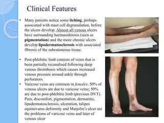 Leg Ulcer.pptx