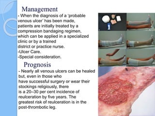 Leg Ulcer.pptx