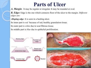 Leg Ulcer.pptx
