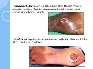 Leg Ulcer.pptx