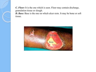 Leg Ulcer.pptx