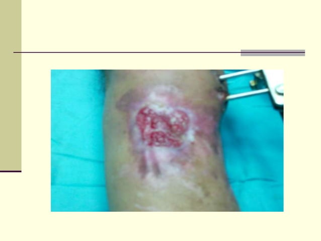 Leg Ulcers Chronic Ppt