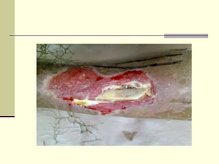 Leg ulcers (chronic | PPTX