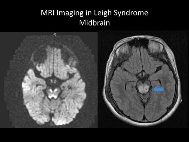 Leigh Syndrome - Mary Kay Koenig, MD | PPTX