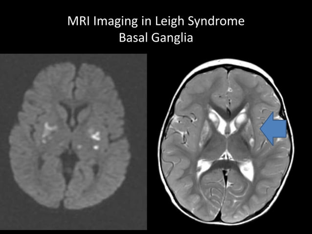 Leigh Syndrome - Mary Kay Koenig, MD | PPTX
