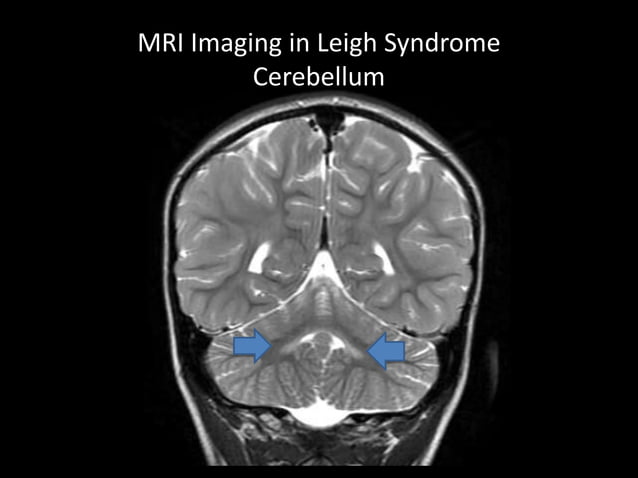 Leigh Syndrome - Mary Kay Koenig, MD | PPTX