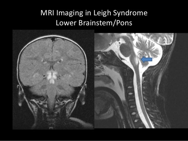 Leigh Syndrome - Mary Kay Koenig, MD
