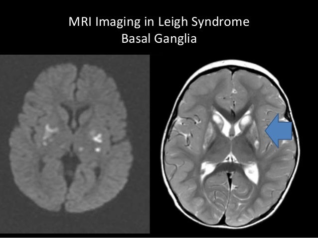 Leigh Syndrome - Mary Kay Koenig, MD